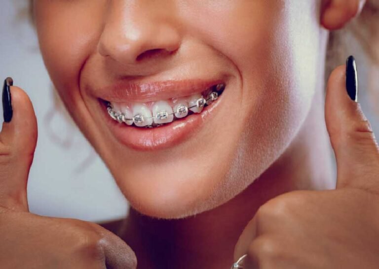 The Path to a Perfect Smile: Why More Adults Are Getting Braces ...
